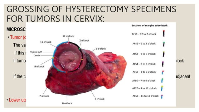 Grossing of hysterectomy specimens | PPTX
