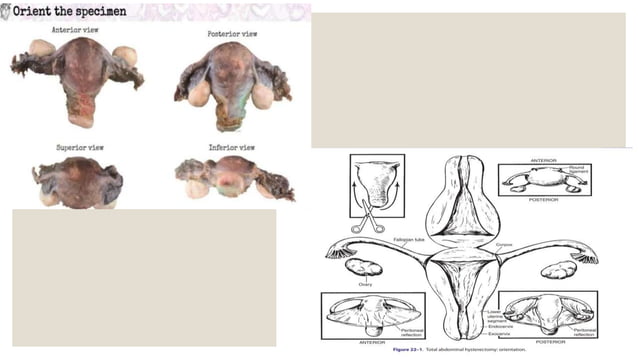 Grossing of hysterectomy specimens | PPTX