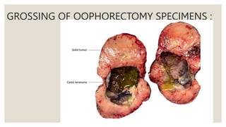 Grossing of hysterectomy specimens | PPT