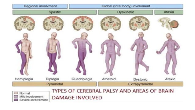 Cerebral palsy physiotherapy management | PPTX | Physical Therapy ...