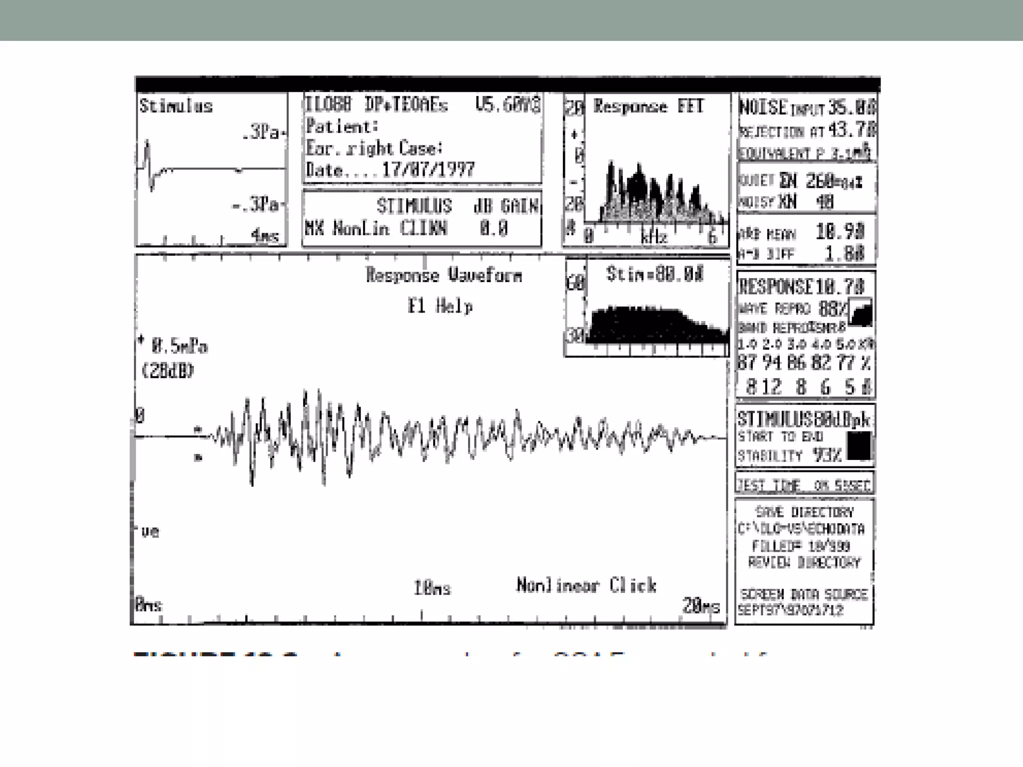 OAE and BERA ( otoacoustic emissions and brainstem evoked response ...