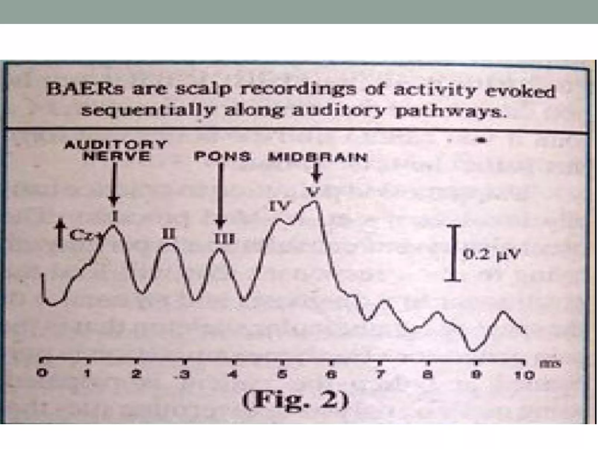 OAE and BERA ( otoacoustic emissions and brainstem evoked response ...
