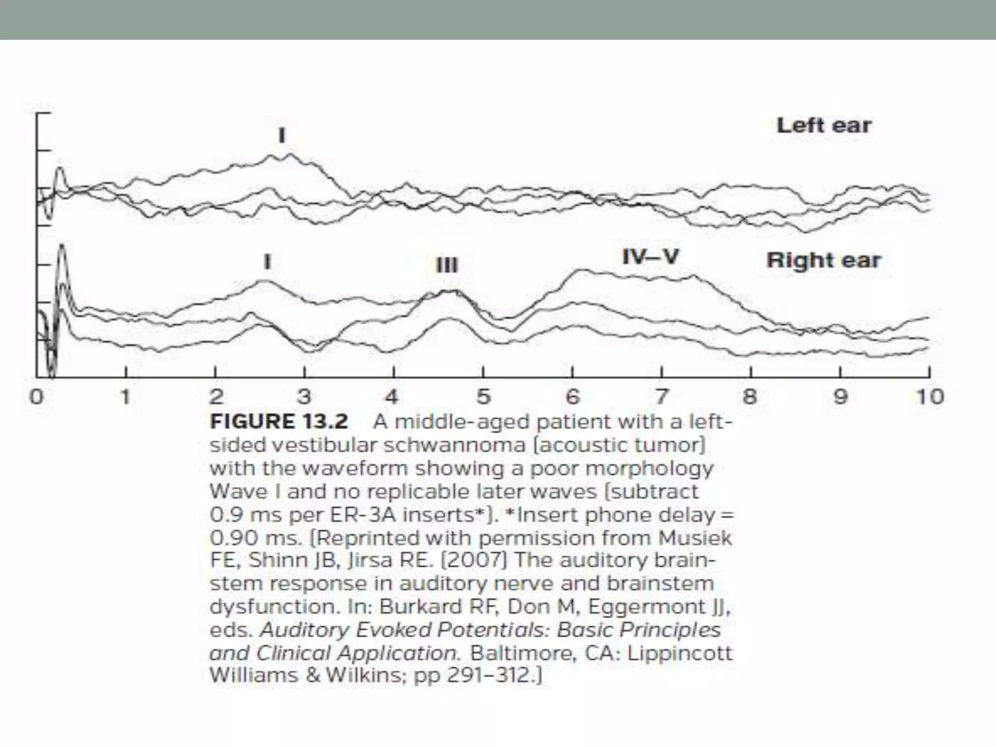 OAE and BERA ( otoacoustic emissions and brainstem evoked response ...