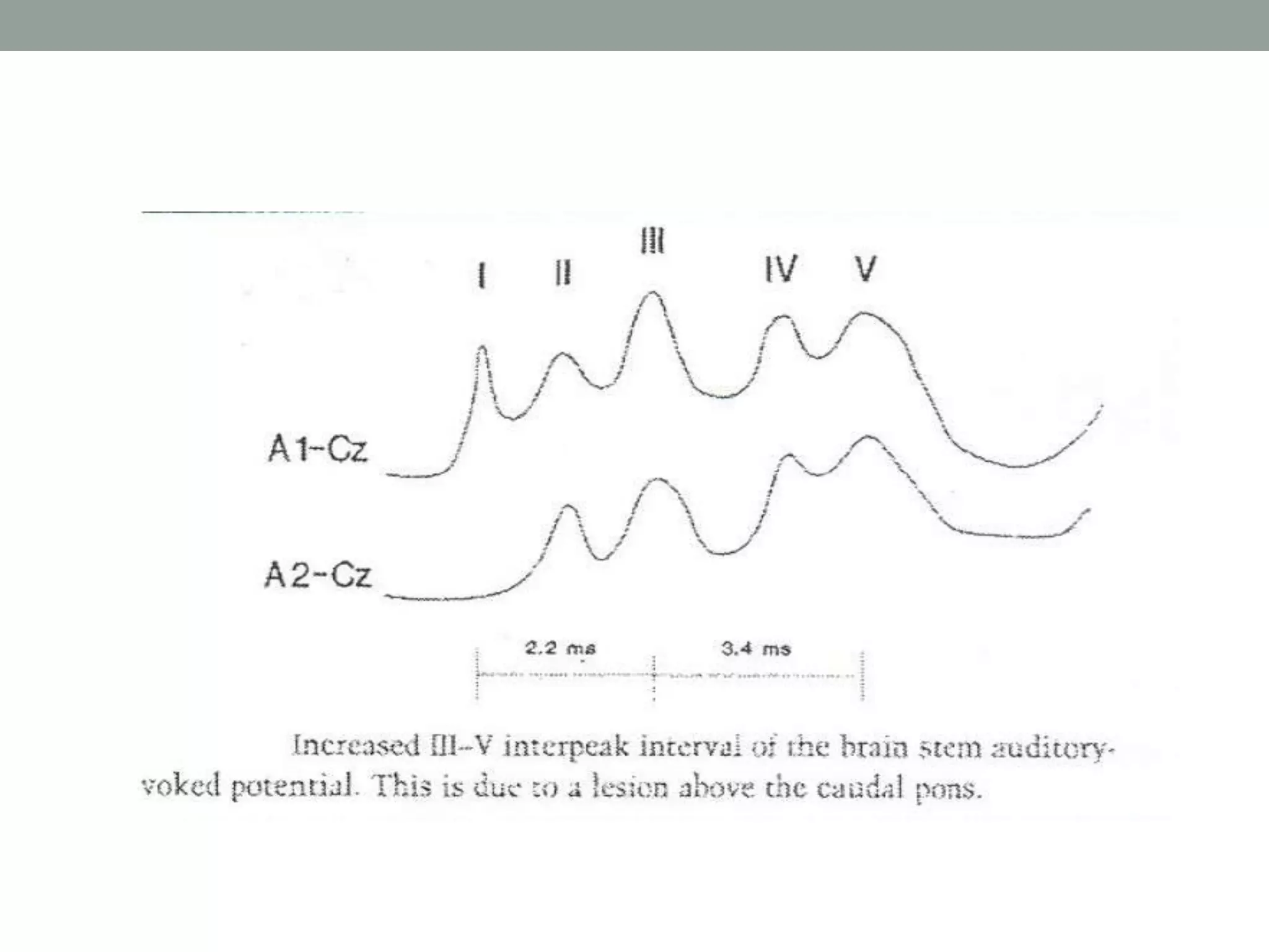 OAE and BERA ( otoacoustic emissions and brainstem evoked response ...