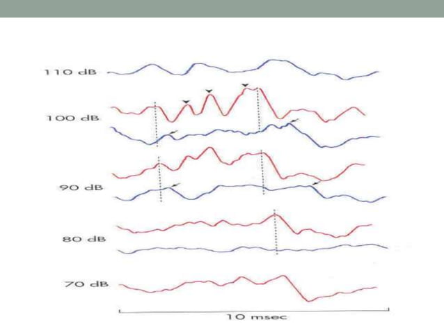 OAE and BERA ( otoacoustic emissions and brainstem evoked response ...