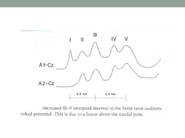 OAE and BERA ( otoacoustic emissions and brainstem evoked response ...