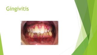 GINGIVITIS.pptx