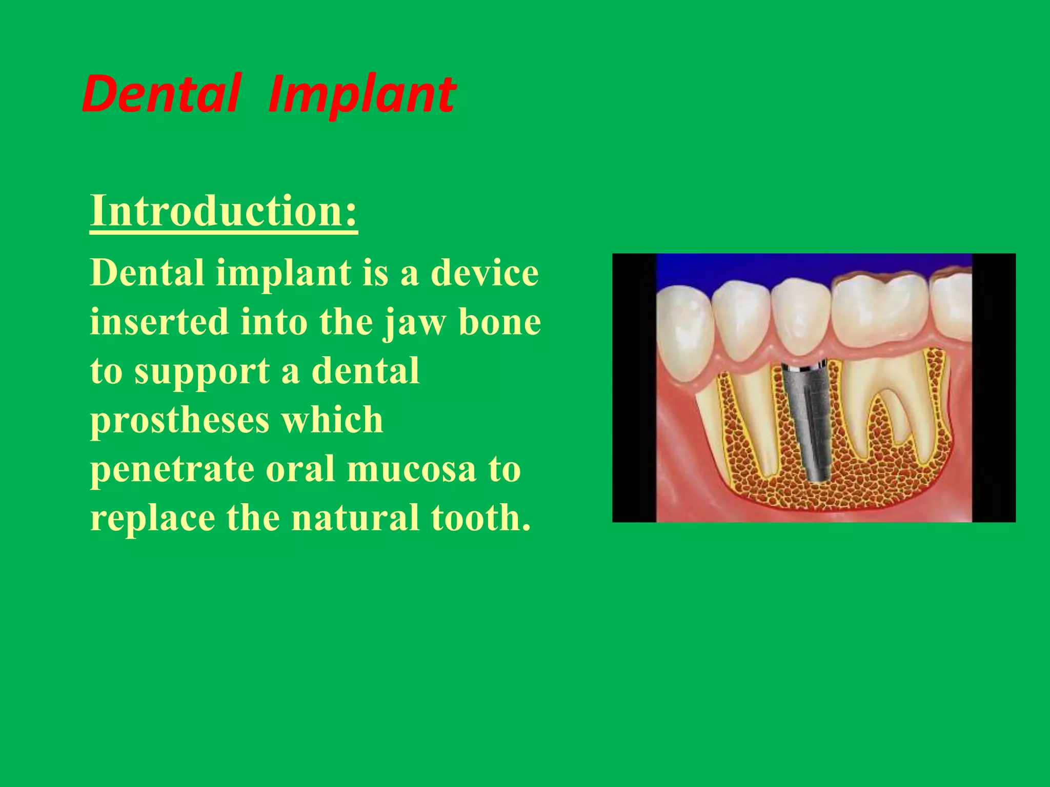 implant supported fixed restorations | PPTX