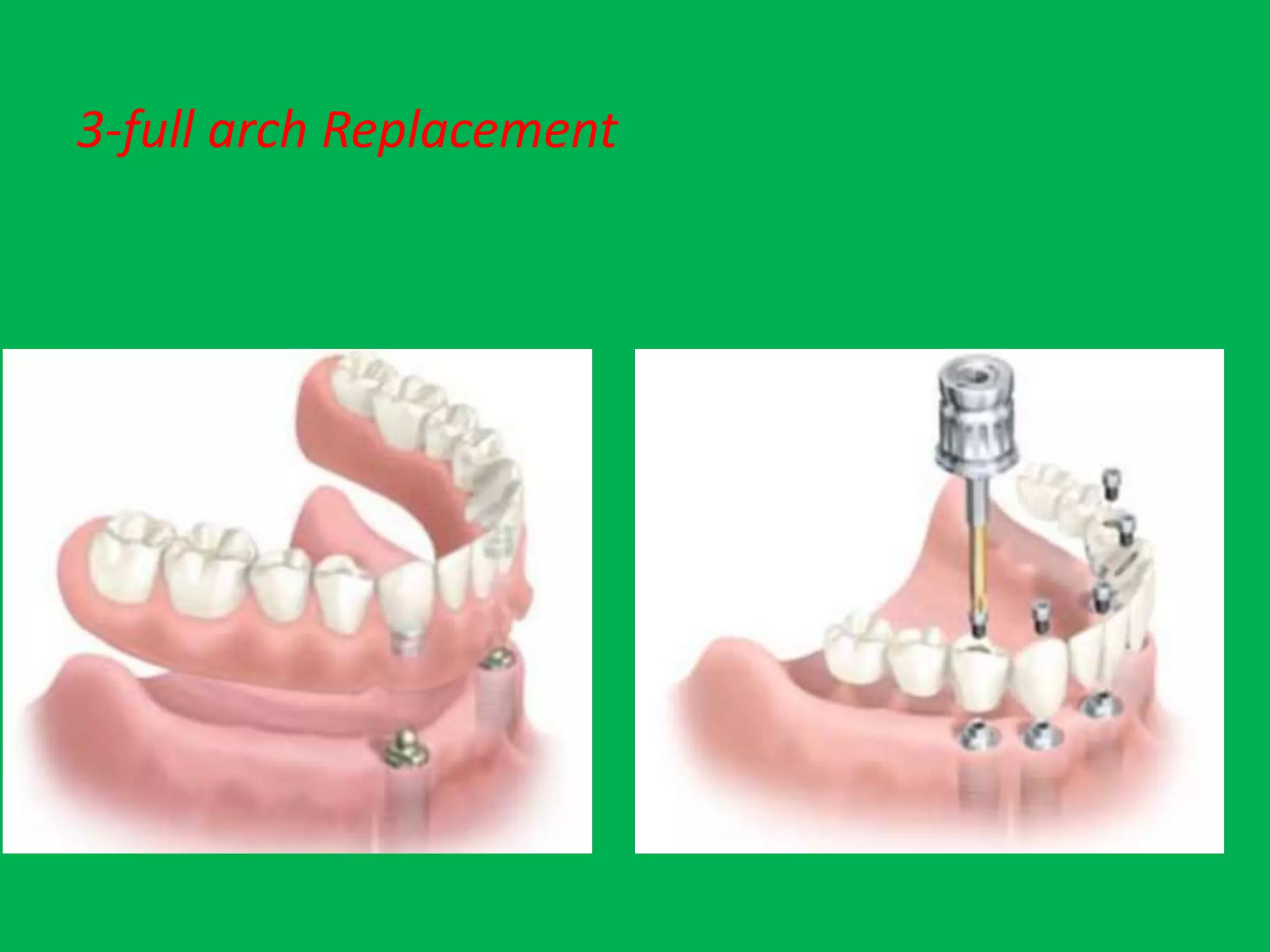 implant supported fixed restorations | PPTX