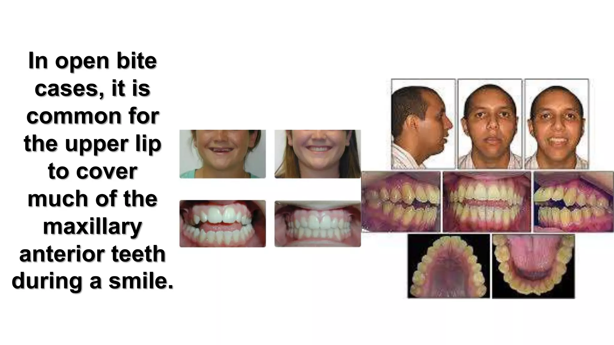 biomechanics of open bite closure by incisor extrusion | PPTX