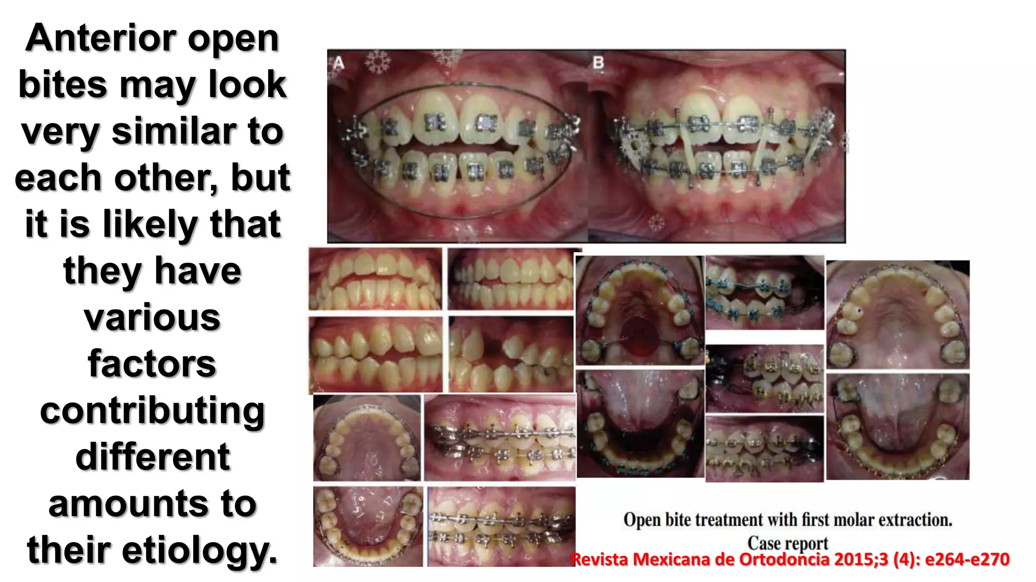biomechanics of open bite closure by incisor extrusion | PPTX