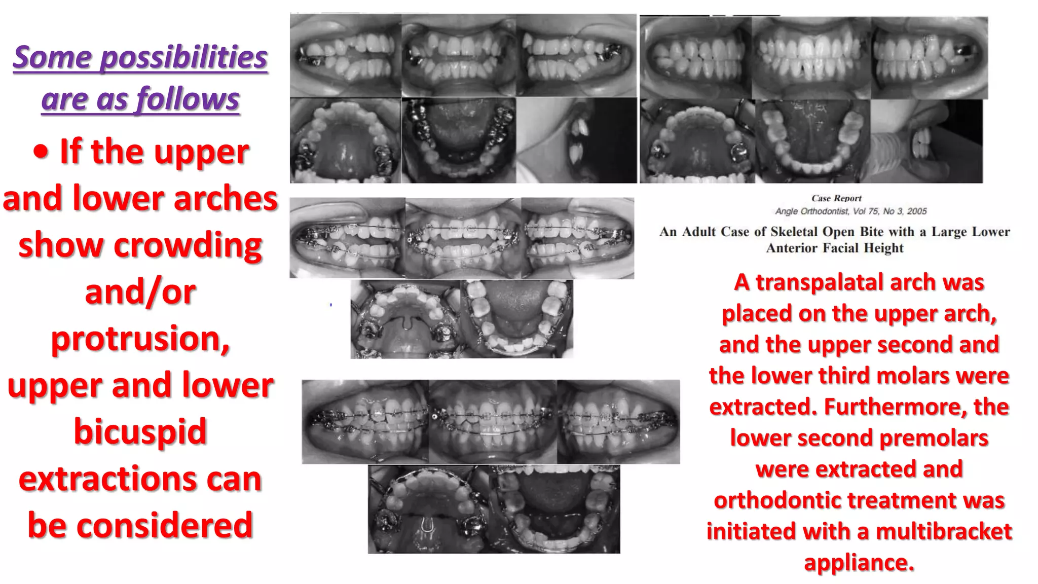 biomechanics of open bite closure by incisor extrusion | PPTX