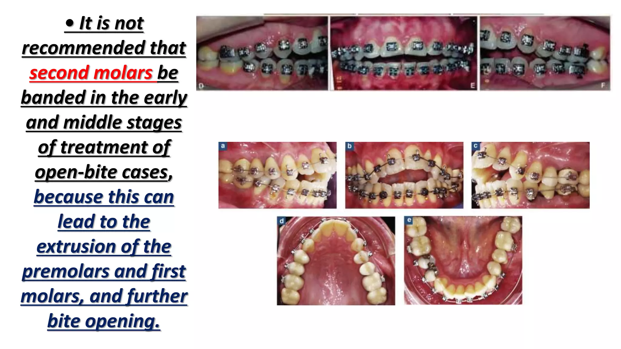 biomechanics of open bite closure by incisor extrusion | PPTX