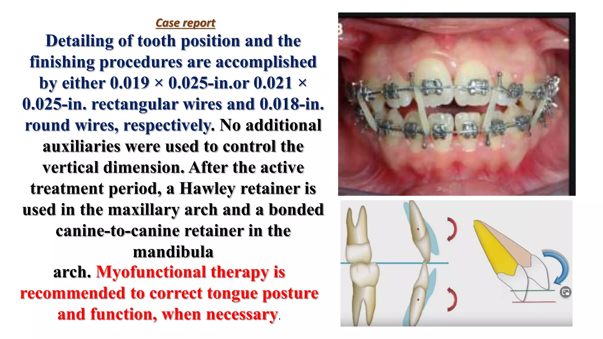 biomechanics of open bite closure by incisor extrusion | PPTX