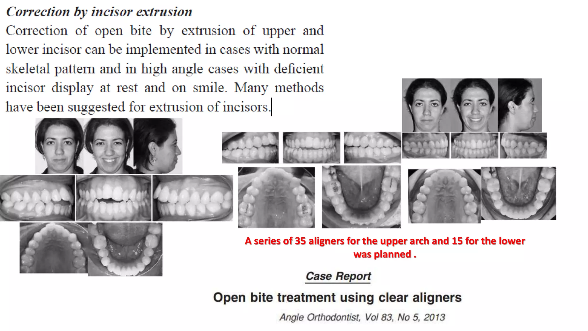 biomechanics of open bite closure by incisor extrusion | PPTX