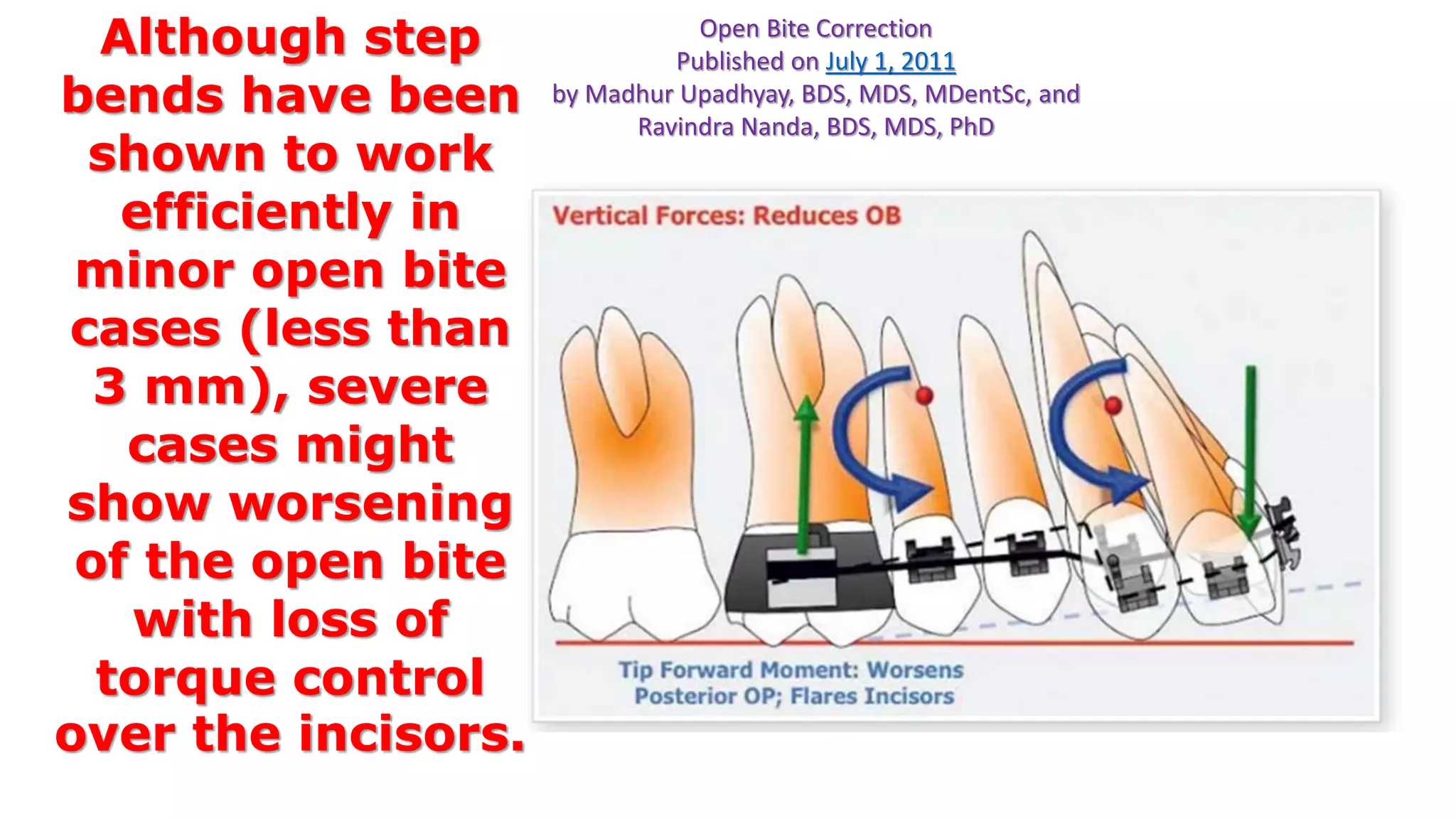 biomechanics of open bite closure by incisor extrusion | PPTX
