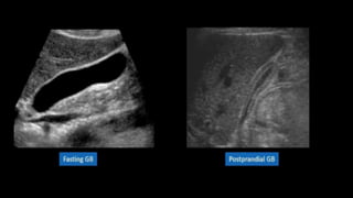 Gallbladder anatomy and the shape by Echo | PDF