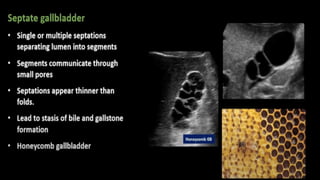 Gallbladder anatomy and the shape by Echo | PDF