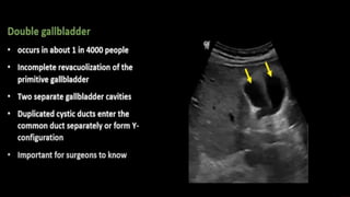 Gallbladder anatomy and the shape by Echo | PDF