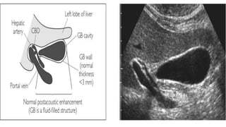 Gallbladder anatomy and the shape by Echo | PDF