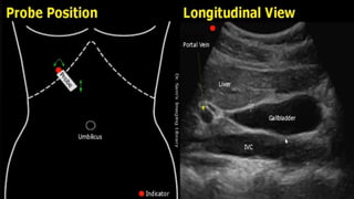 Gallbladder anatomy and the shape by Echo | PDF