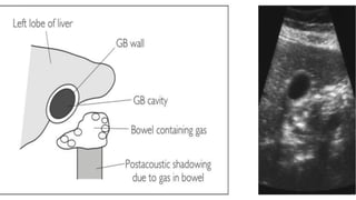 Gallbladder anatomy and the shape by Echo | PDF