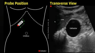 Gallbladder anatomy and the shape by Echo | PDF