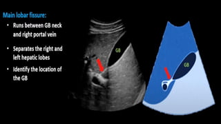 Gallbladder anatomy and the shape by Echo | PDF