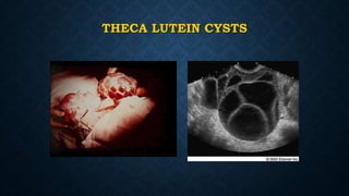 OVARIAN TUMOURS | PPTX