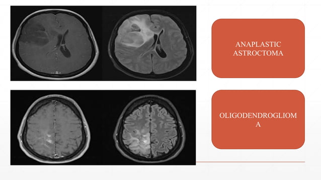 high grade glioma | PPTX | Brain and Nervous System Disorders ...