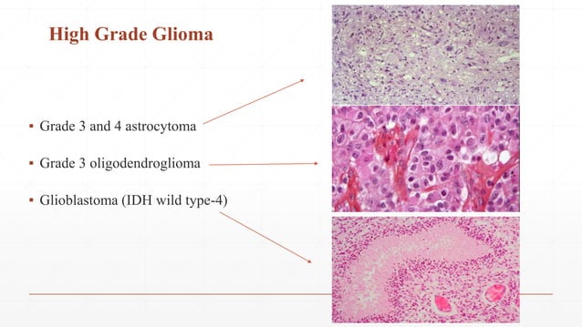 high grade glioma | PPTX | Brain and Nervous System Disorders ...