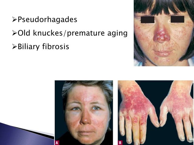 Porphyrias ...heme metabolism, pathophysiology, classification | PPTX ...