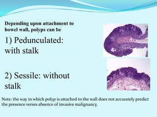 polyposis syndromes | PPTX