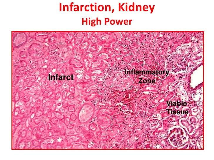 Kidney Infarct Nus Pathology