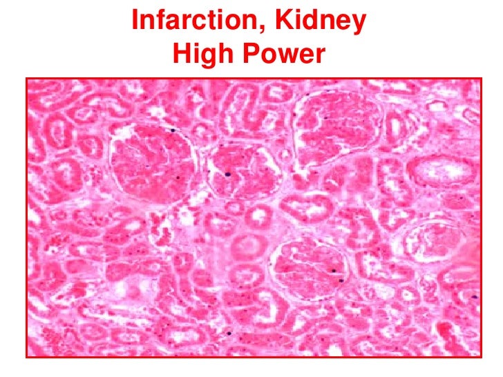 Kidney Infarct Nus Pathology