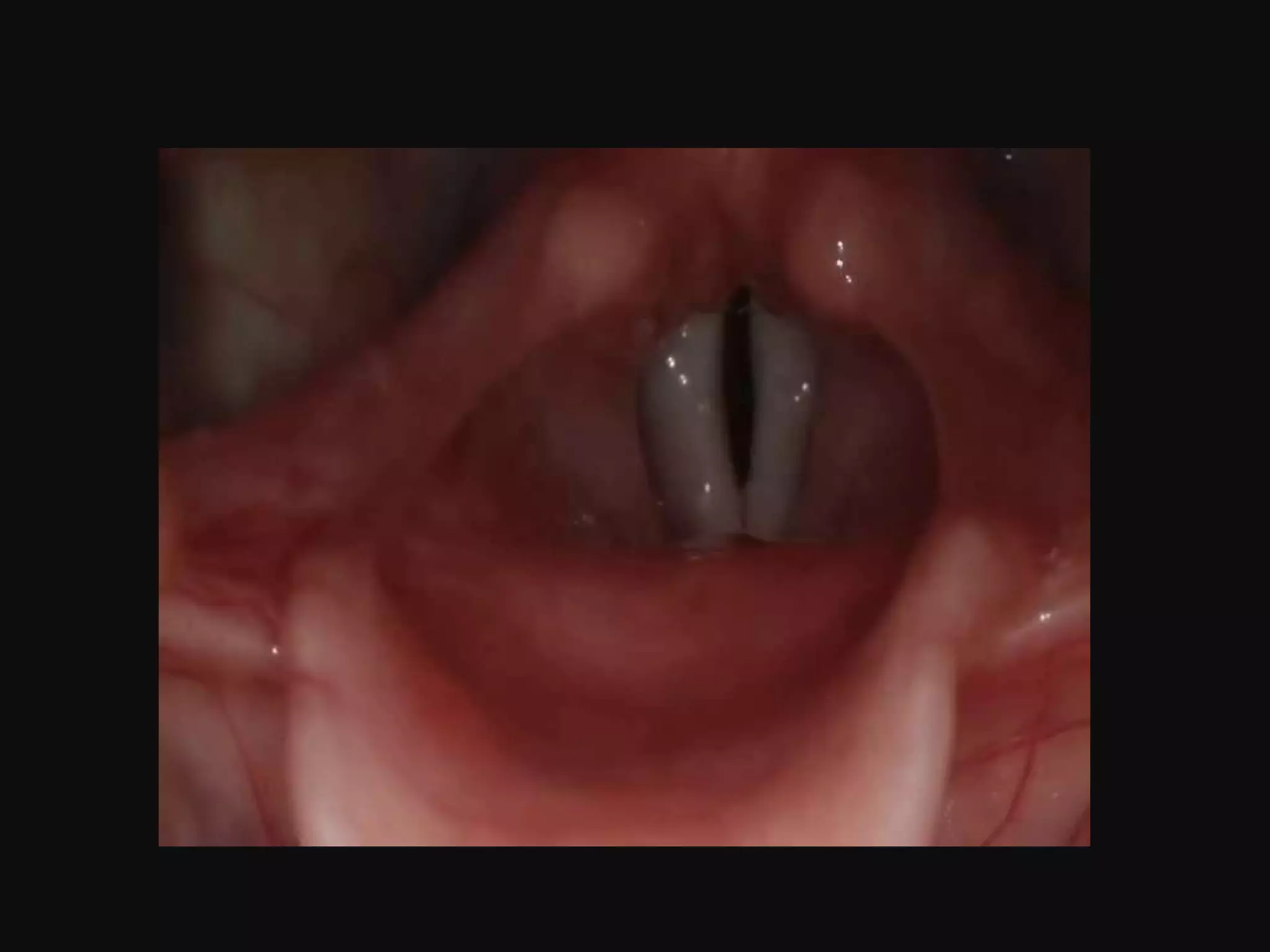 Vocal Cord Lesions And Phonomicrosurgery Pptx 1658