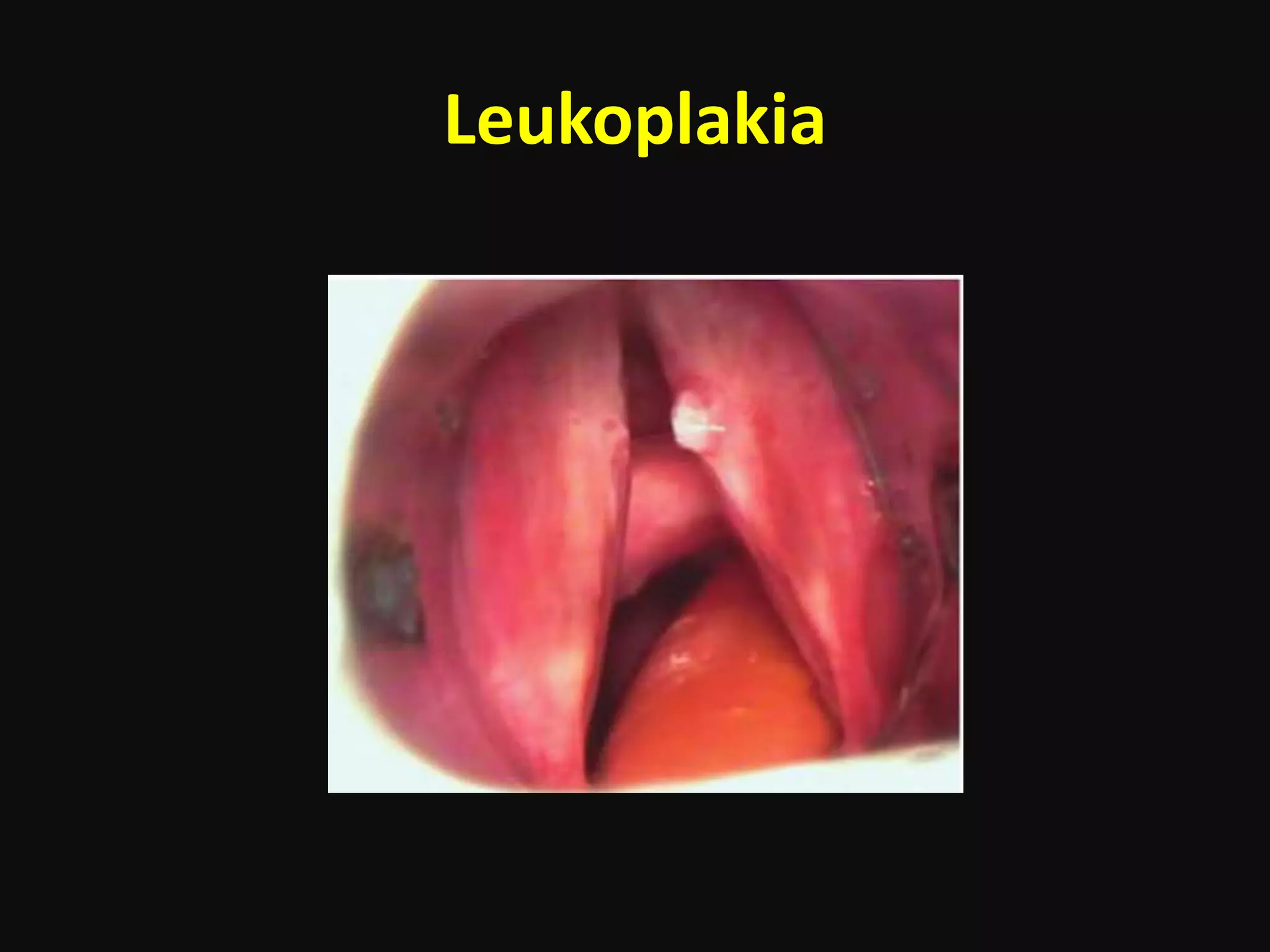 Vocal cord lesions and Phonomicrosurgery | PPTX