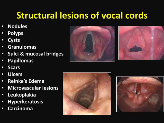 Vocal Fold Lesions | Lesions Cordes Vocales – KBGPTI