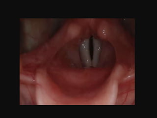 Vocal cord lesions and Phonomicrosurgery | PPTX