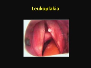 Vocal cord lesions and Phonomicrosurgery | PPT