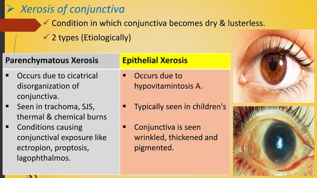 New real conjunctiva ,episclera ,sclera | PPT