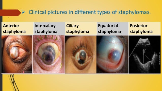 New real conjunctiva ,episclera ,sclera
