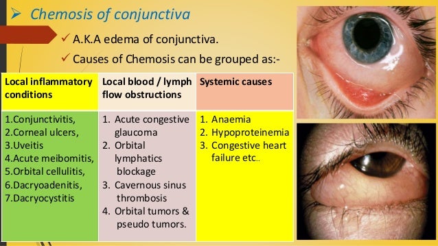 New real conjunctiva ,episclera ,sclera
