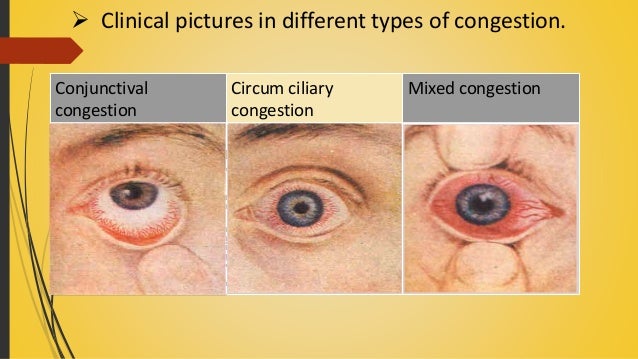 New real conjunctiva ,episclera ,sclera