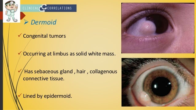 New real conjunctiva ,episclera ,sclera