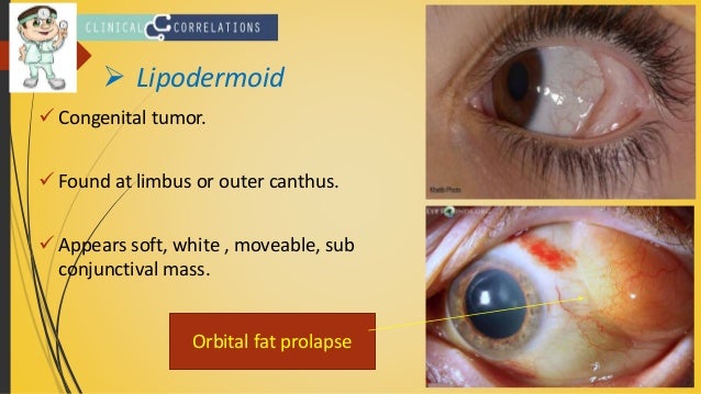 New real conjunctiva ,episclera ,sclera