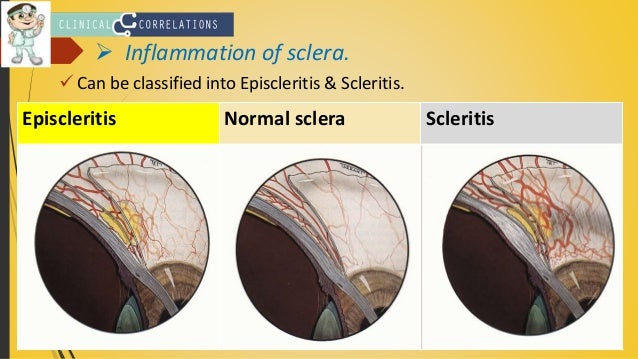 New real conjunctiva ,episclera ,sclera