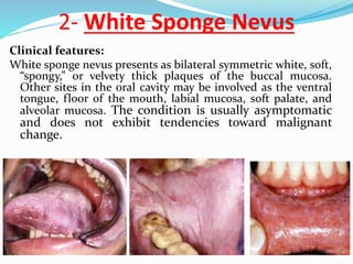 White Sponge Nevus Tongue