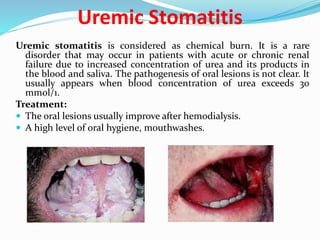 Uremic Stomatitis