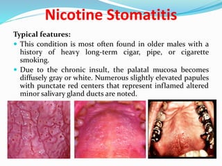 Nicotine Stomatitis